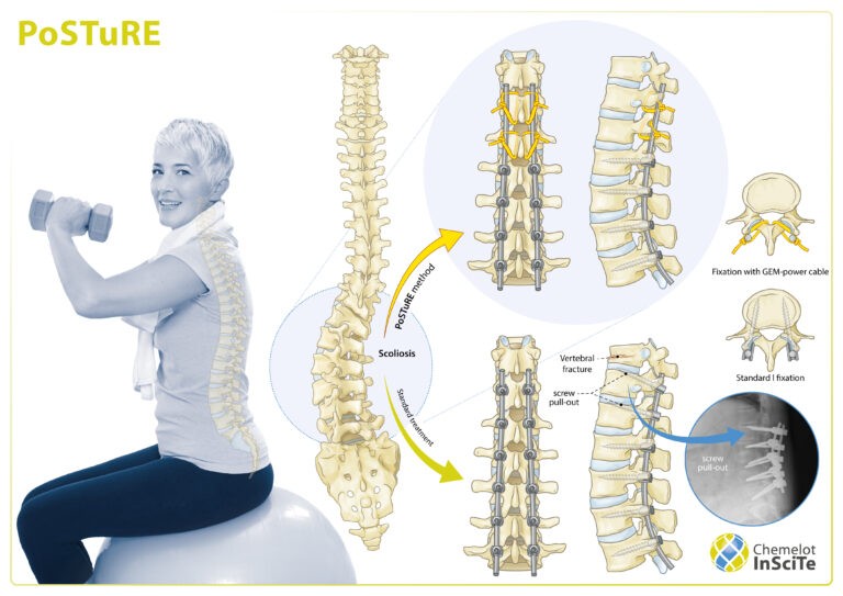 PoSTuRE-ENG - Medace